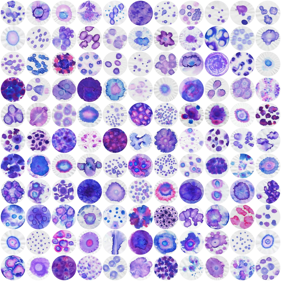 Brain Cancer Cells Under Microscope