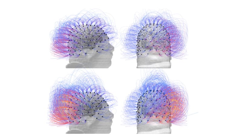 Precise Electrical Stimulation May Lift Patients from Vegetative States ...